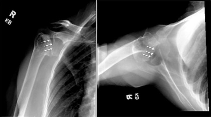 Proximal Humerus Fracture | Boston Shoulder Institute
