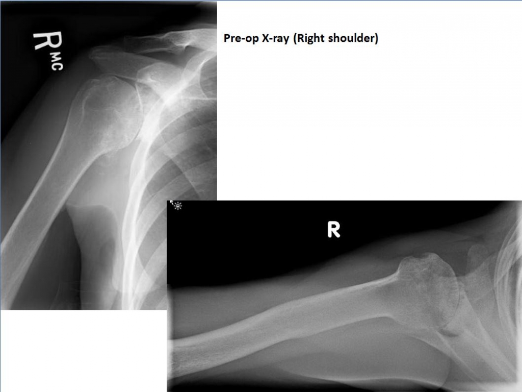 Reverse Total Shoulder Replacement | Boston Shoulder Institute