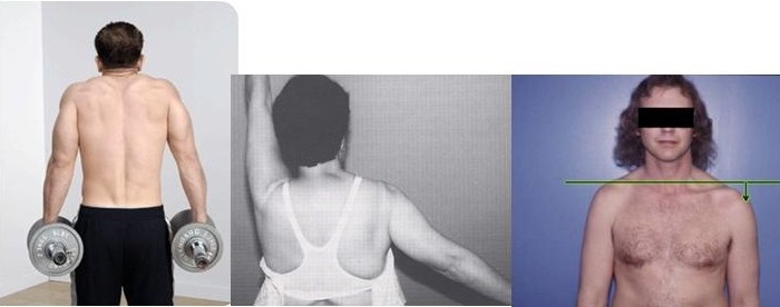 Scapulothoracic Winging | Boston Shoulder Institute