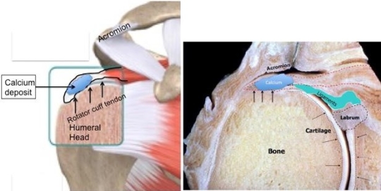 Calcific Tendonitis | Boston Shoulder Institute