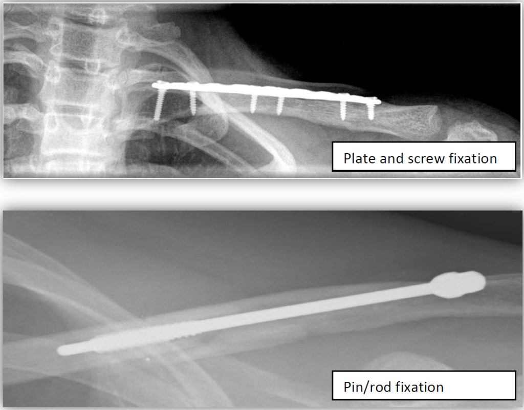 Clavicle (Collar Bone) Fractures | Boston Shoulder Institute