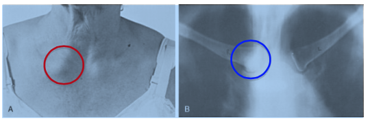 Sternoclavicular Joint | Boston Shoulder Institute