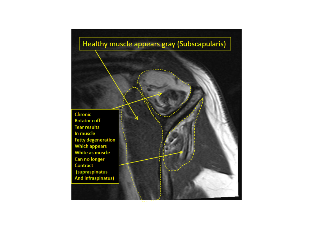 New Approaches in RSA | Boston Shoulder Institute