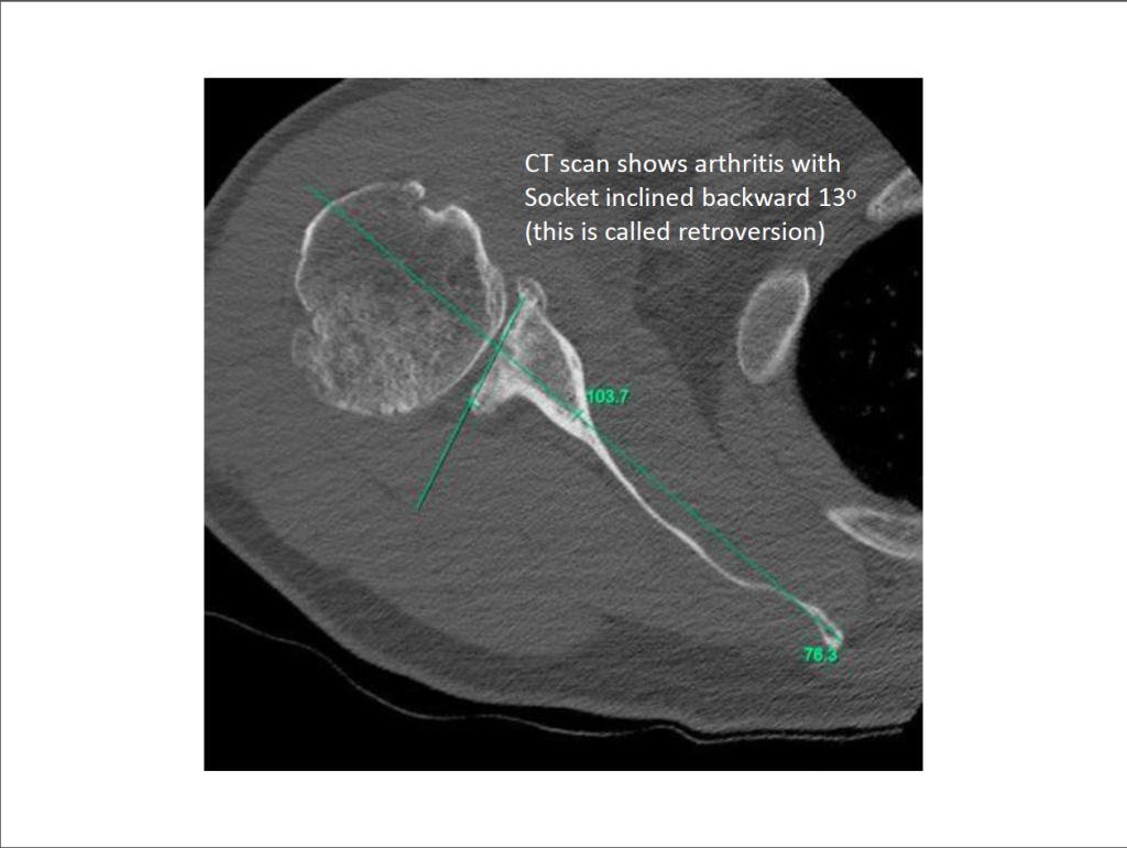 New Technology in Total Shoulder Arthroplasty | Boston Shoulder Institute