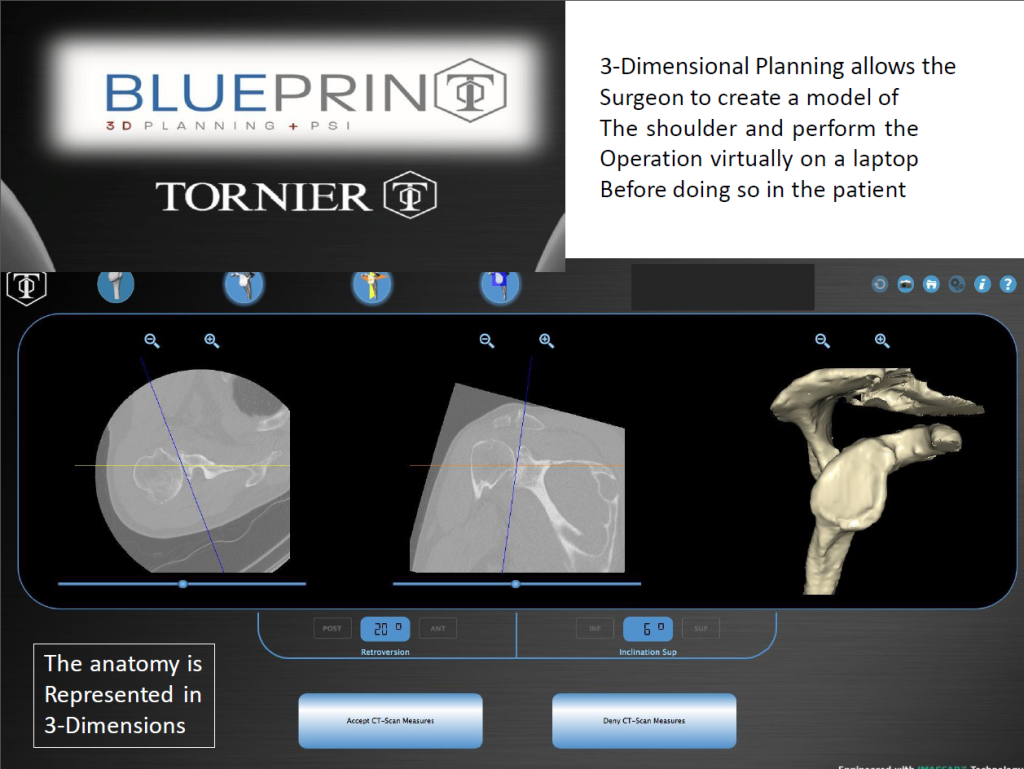 New Technology in Total Shoulder Arthroplasty | Boston Shoulder Institute