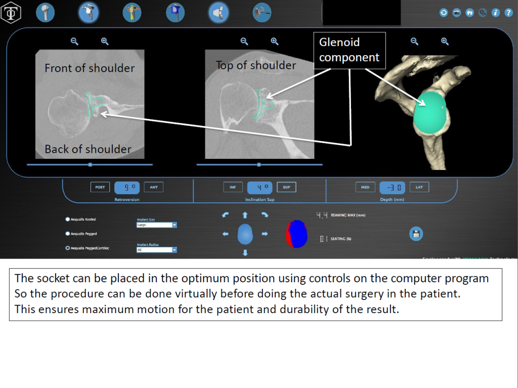 New Technology in Total Shoulder Arthroplasty | Boston Shoulder Institute