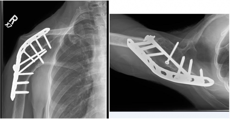 Glenohumeral Fusion Pt Testimonial | Boston Shoulder Institute