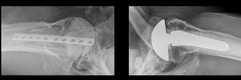 Prostalac Spacer for Infection | Boston Shoulder Institute