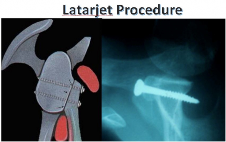 Instability | Boston Shoulder Institute